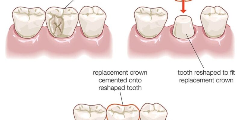 Why Do I Need a Crown? - Dentist in Cinnaminson NJ - Rapha Dental LLC